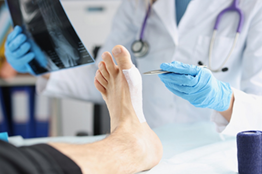 Minimally Invasive Surgery for Heel Spurs